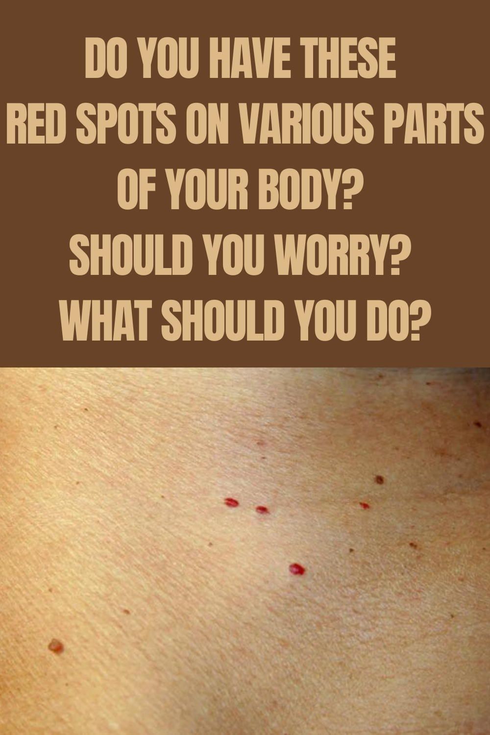 Do You Have These Red Spots On Various Parts Of Your Body? Should You ...