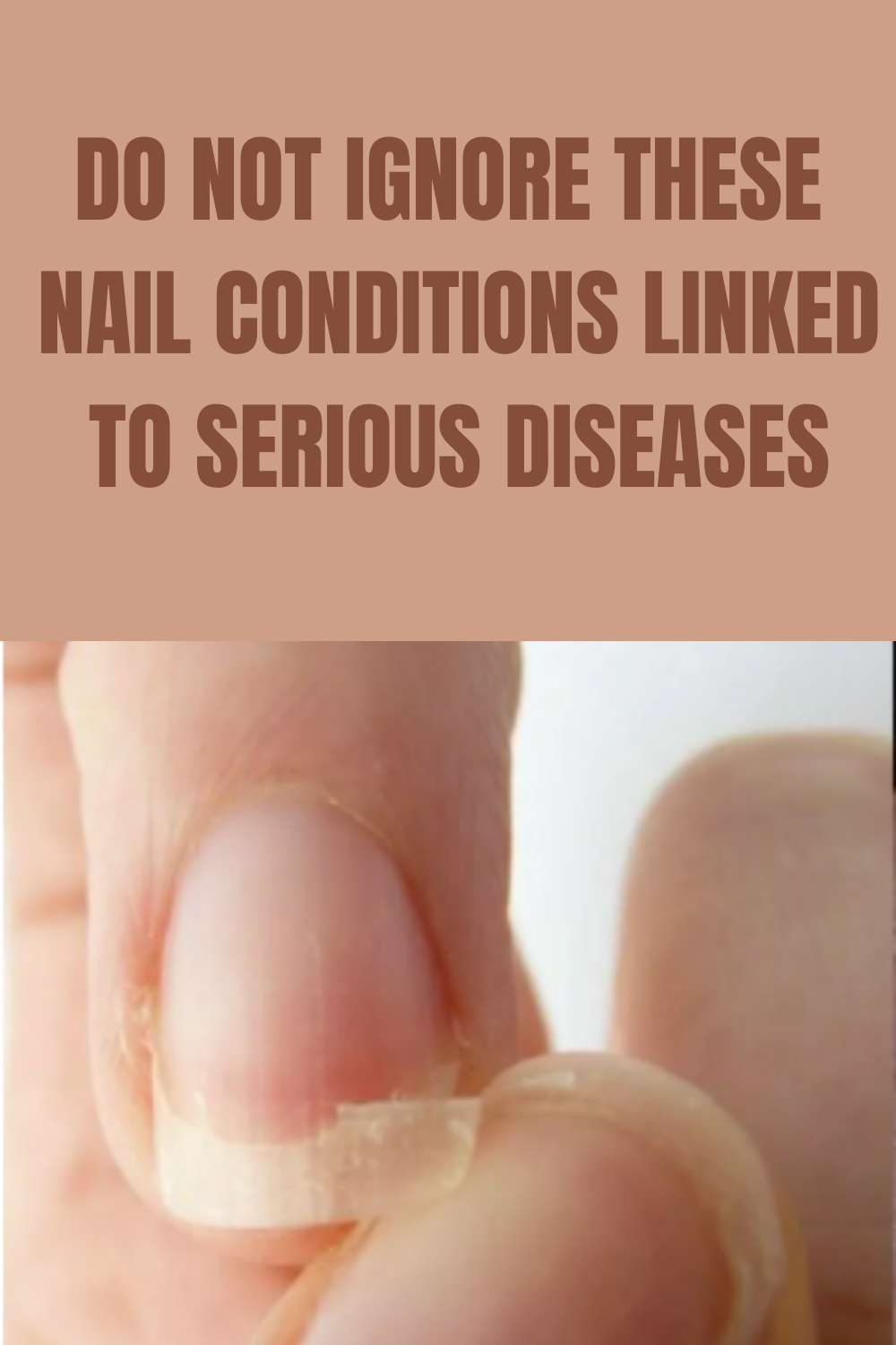 Do Not Ignore These Nail Conditions Linked To Serious Diseases - Daily ...