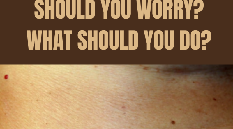 DO YOU HAVE THESE RED SPOTS ON VARIOUS PARTS OF YOUR BODY? SHOULD YOU ...