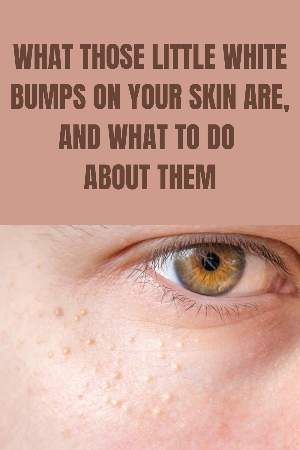 What Those Little White Bumps on Your Skin Are, and What to Do About ...